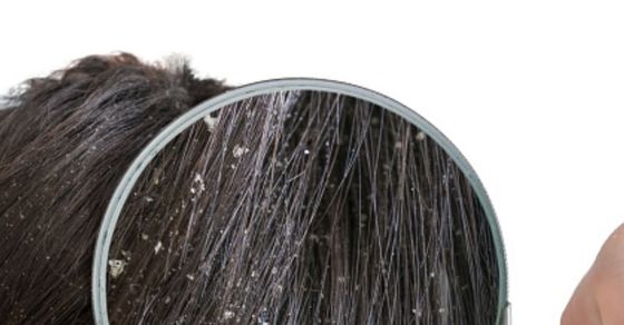 Remedies For Dandruff : Home Remedies to get rid of Dandruff - बालों ...