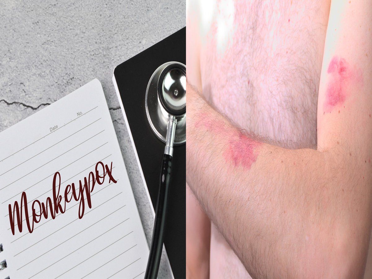 Monkeypox Explainer What is Monkeypox and what are its symptoms How to beware of Monkeypox ...