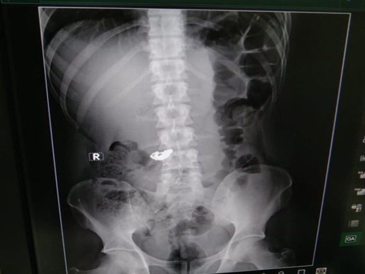 OMG: महिला से सोने की चेन छीनकर निगल गया शख्स, फिर पुलिस और डॉक्टर्स ने ...