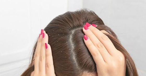 Winter dandruff how to prevent: Winter Dandruff Tips: सर्दी के मौसम में ...