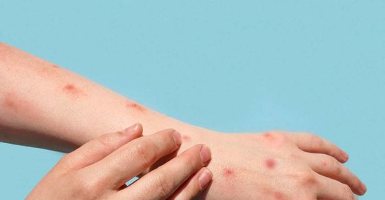 First death due to monkeypox in India Kerala youth had tested positive ...
