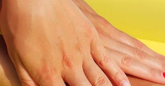 Skin Care Tips: Skin Care Tips For Health How To Remove Tanning From ...